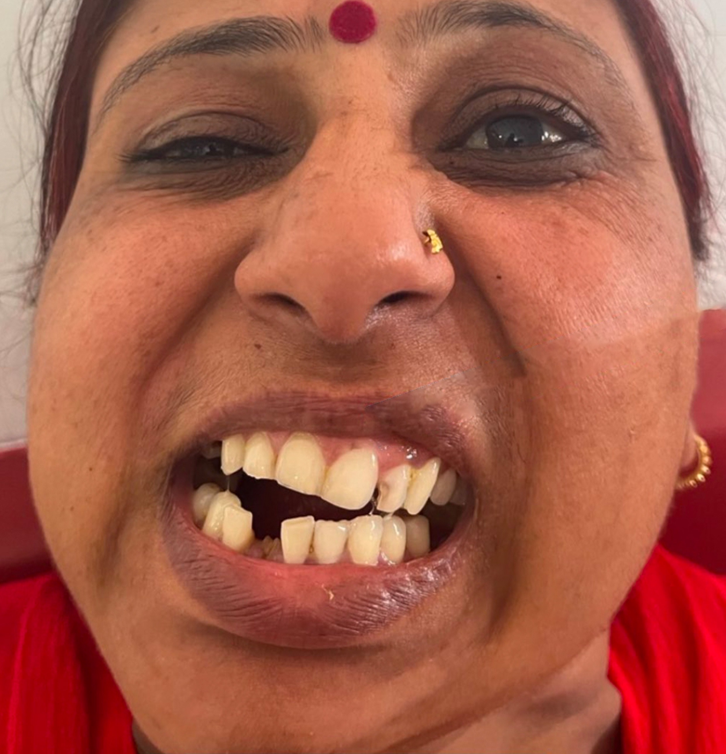 India's No.1 Best TMJ Replacement Hospital In India