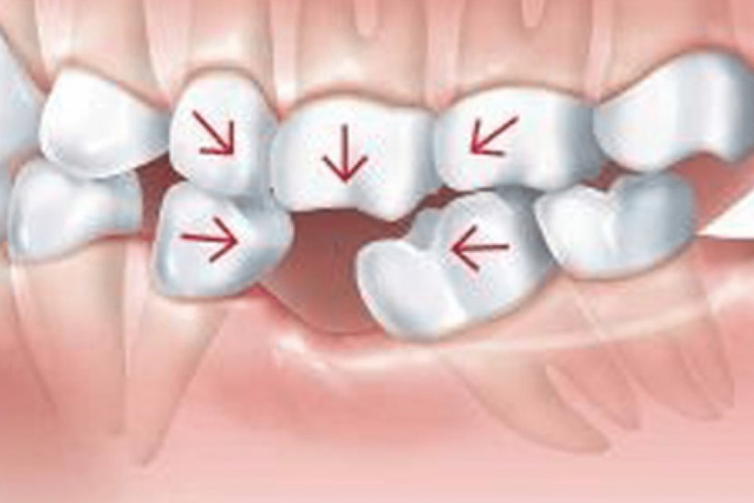 Do You Have Problems With Missing Teeth? – Richardsons