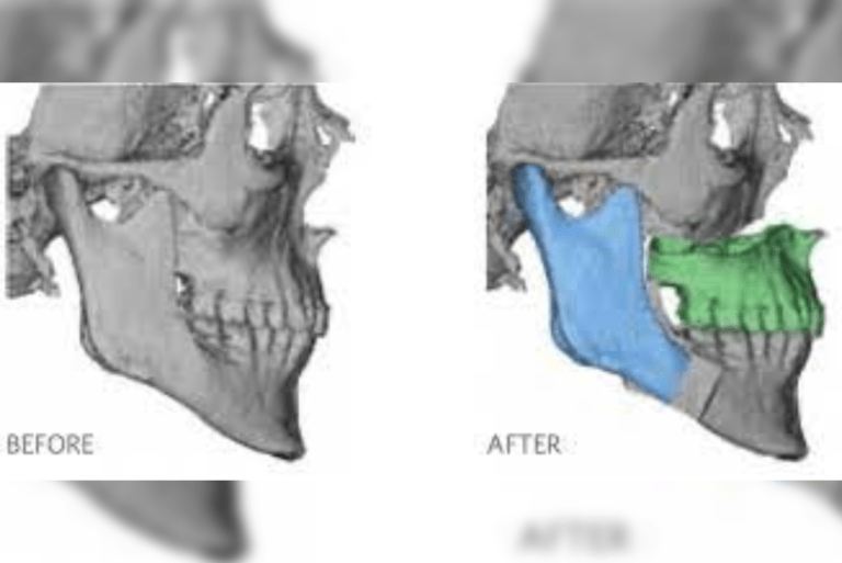 Maxillomandibular Treatment At Richardsons Face Hospitals