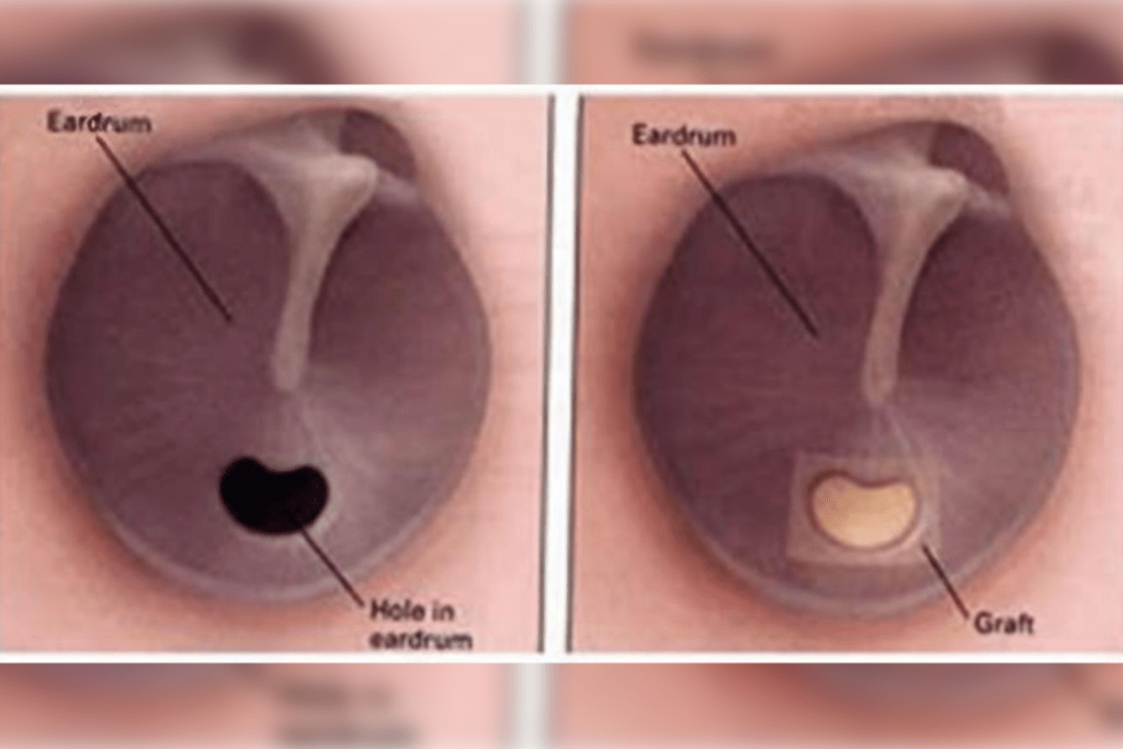 How To Fix Your Ruptured Ear Drum : Tympanoplasty – Richardsons