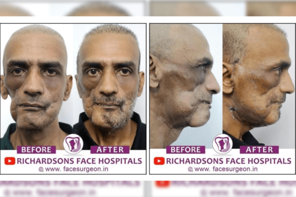 Post-Cancer Facial Reconstruction – Richardsons