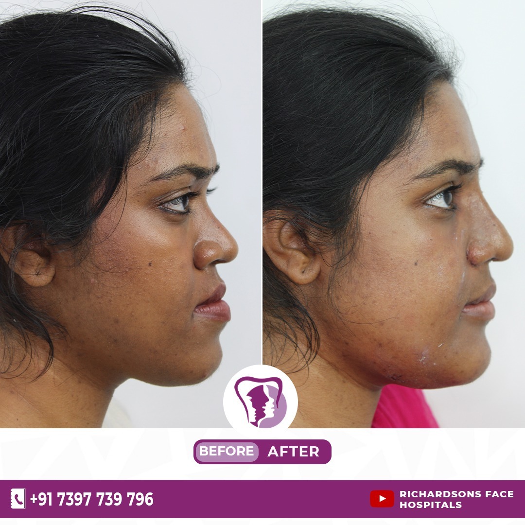 Best Jaw Surgery In India | Orthognathic Surgery