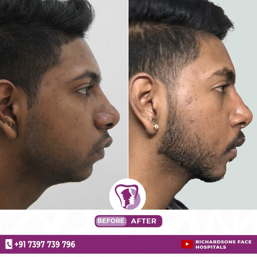 Best Jaw Surgery In India | Orthognathic Surgery