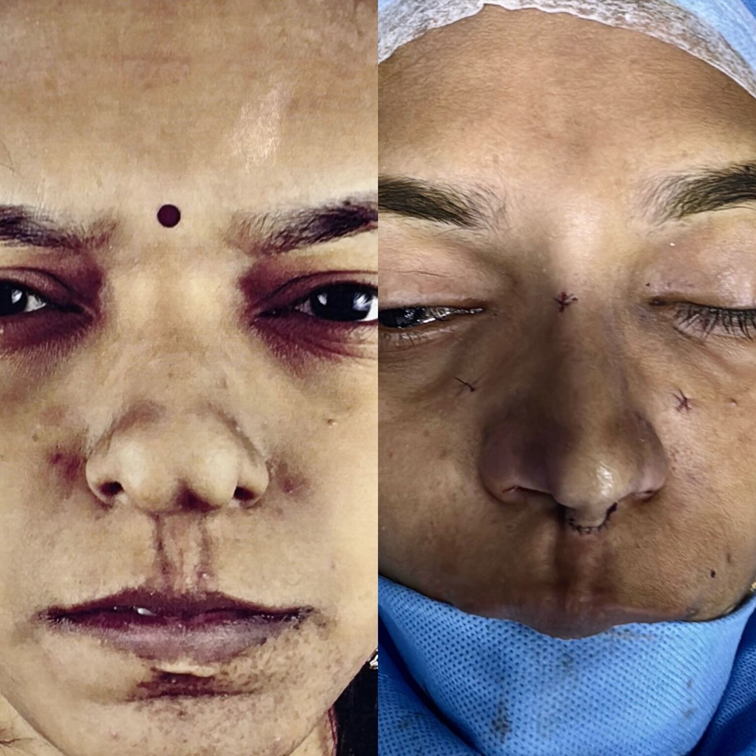 Open Structure Rhinoplasty At India's First Face Hospital | Richardsons ...