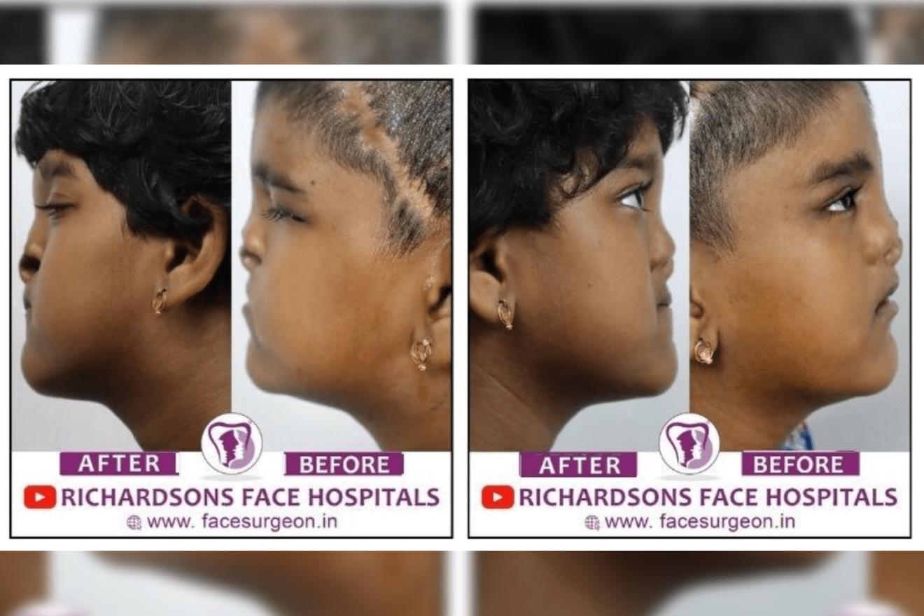 Understanding Tessier Clefts - Richardsons