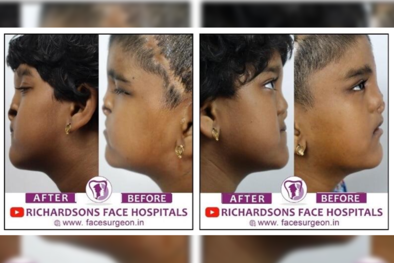 Understanding Tessier Clefts - Richardsons