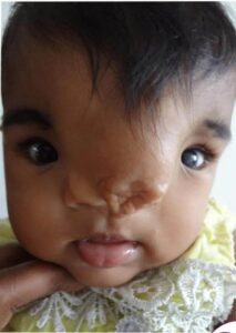 Understanding Tessier Clefts - Richardsons