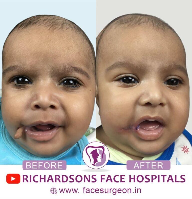 Understanding Tessier Clefts - Richardsons