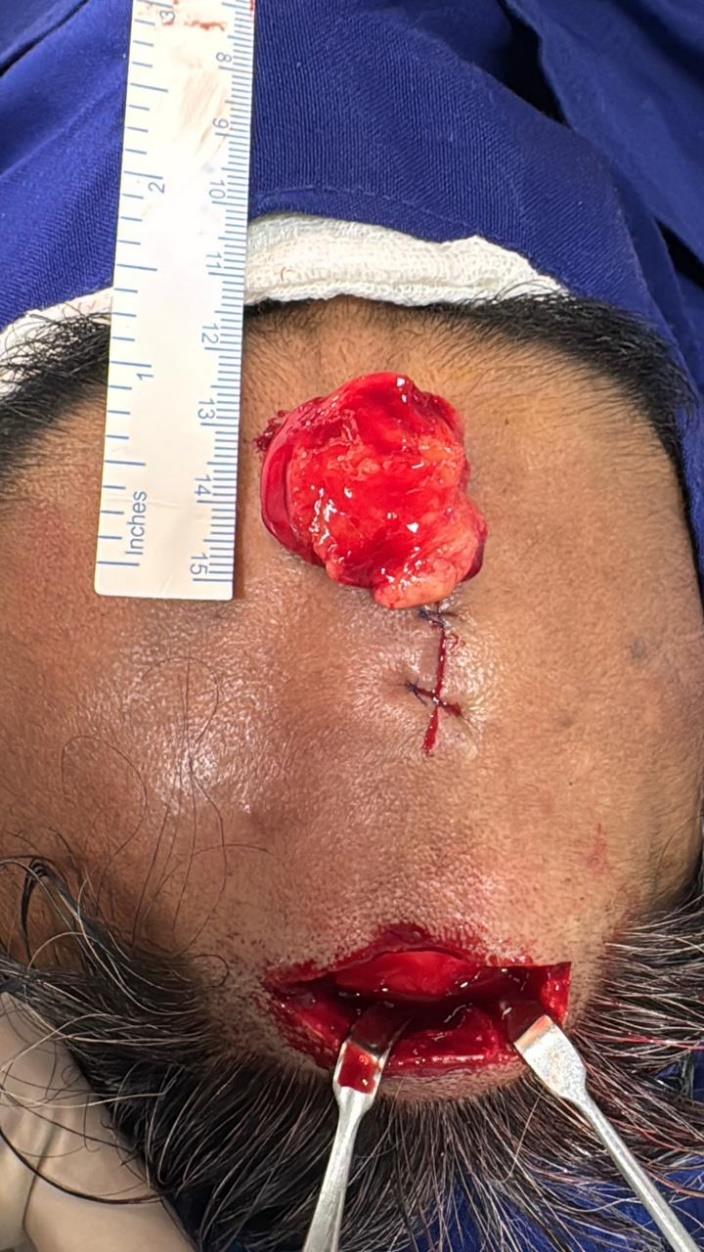 Lipoma On Face: A Unique Concern – Richardsons