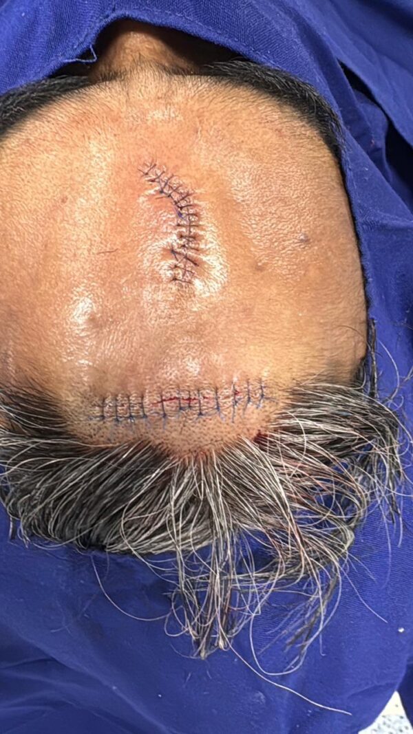 Lipoma On Face: A Unique Concern – Richardsons