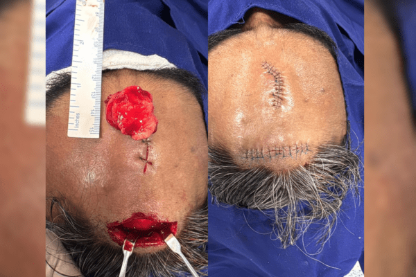 Lipoma On Face: A Unique Concern – Richardsons