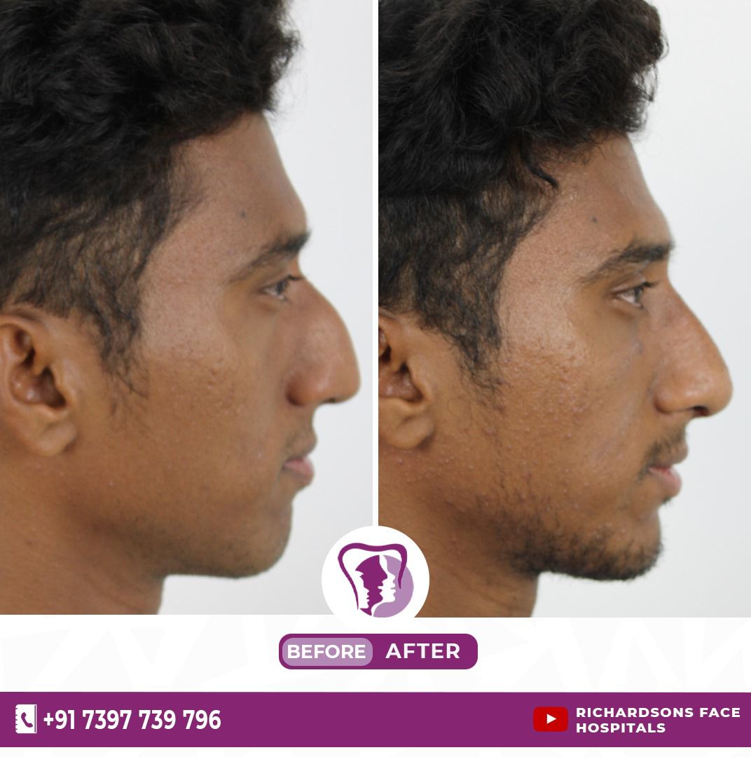Reduction Rhinoplasty At India's First Face Hospital | Richardsons Face ...